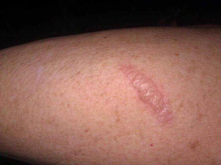 Do Oven Burns Scar